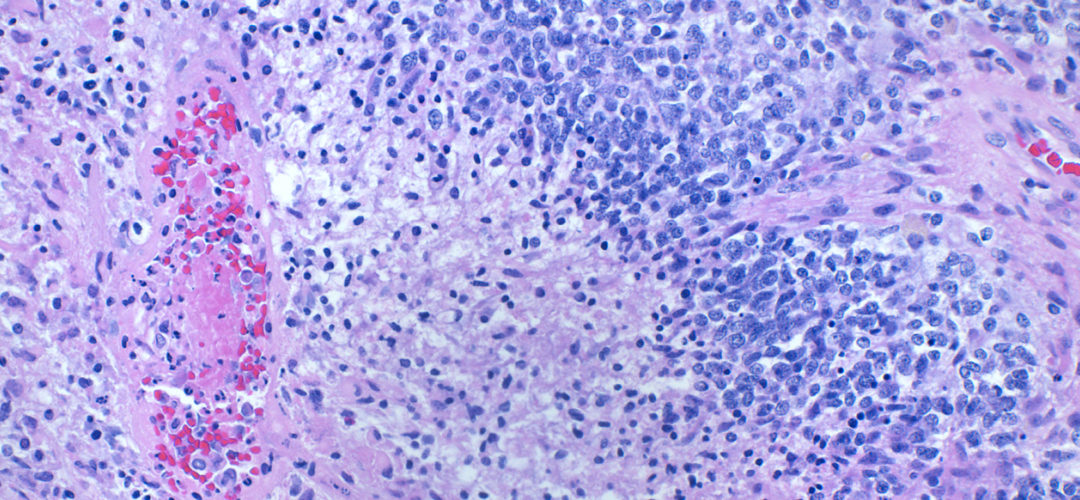 Resources - Brain Tumor | Johns Hopkins Pathology Resources - Brain Tumor | Johns Hopkins Pathology