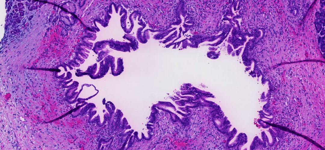 Classification of PanIN Lesions in the Pancreas - Pancreatic Cancer ...